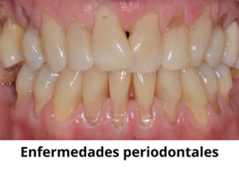 ¿Por qué se retraen las encías? - Clinica Dental Urumea