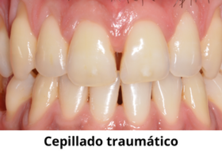 ¿Por qué se retraen las encías? - Clinica Dental Urumea