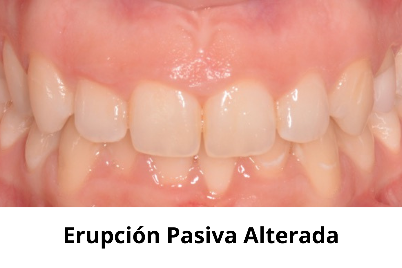 EPA - Tratando la sonrisa gingival - Clinica Dental Urumea
